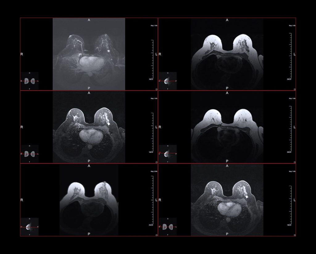 Breast MRI • Touchstone Medical Imaging • Dense Breast Scan