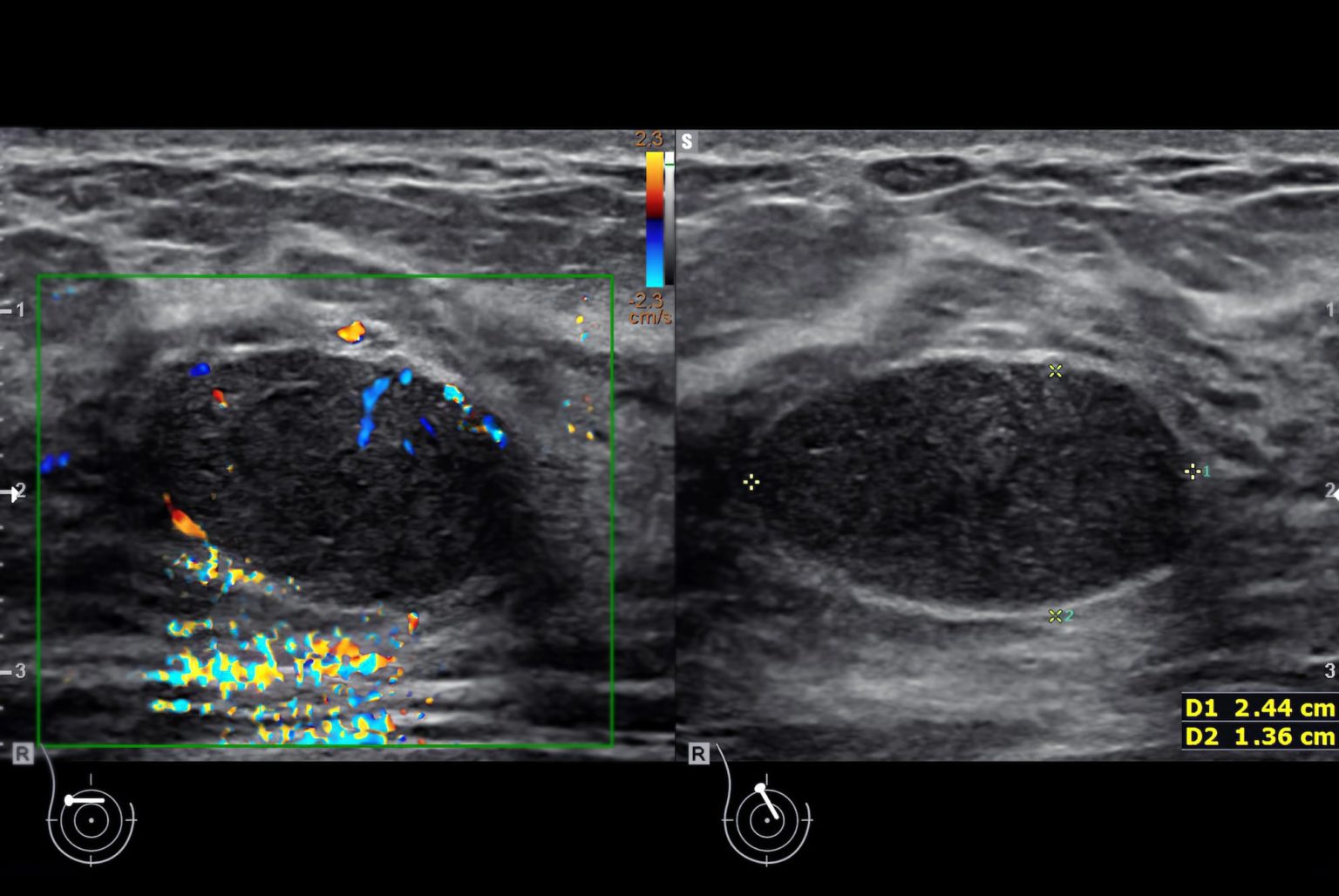 Automated Breast Ultrasound • Touchstone Medical Imaging