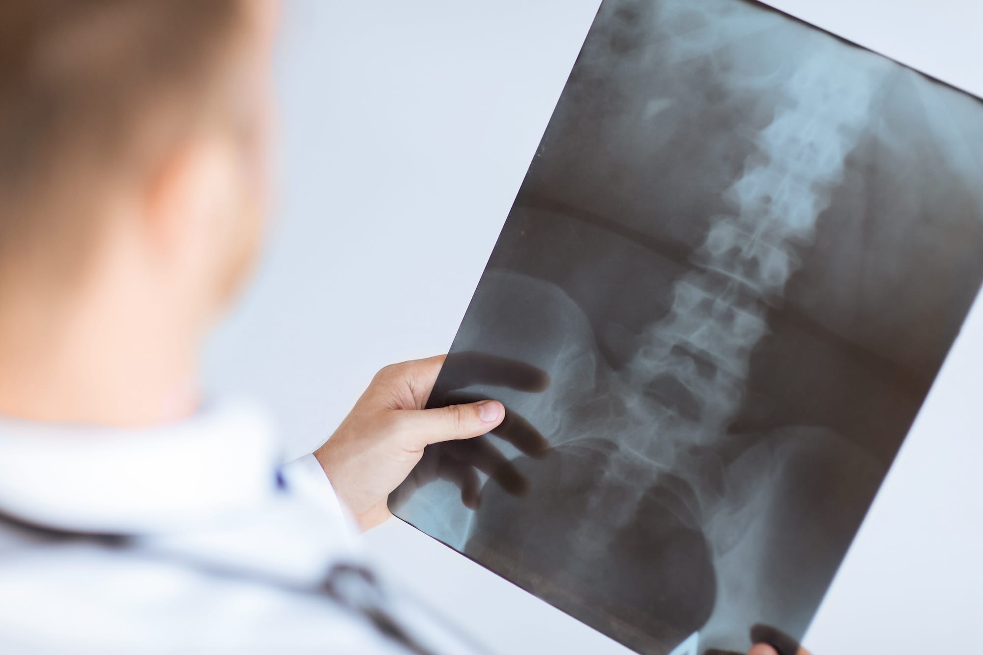 Myelogram Spinal Imaging • Touchstone Medical Imaging