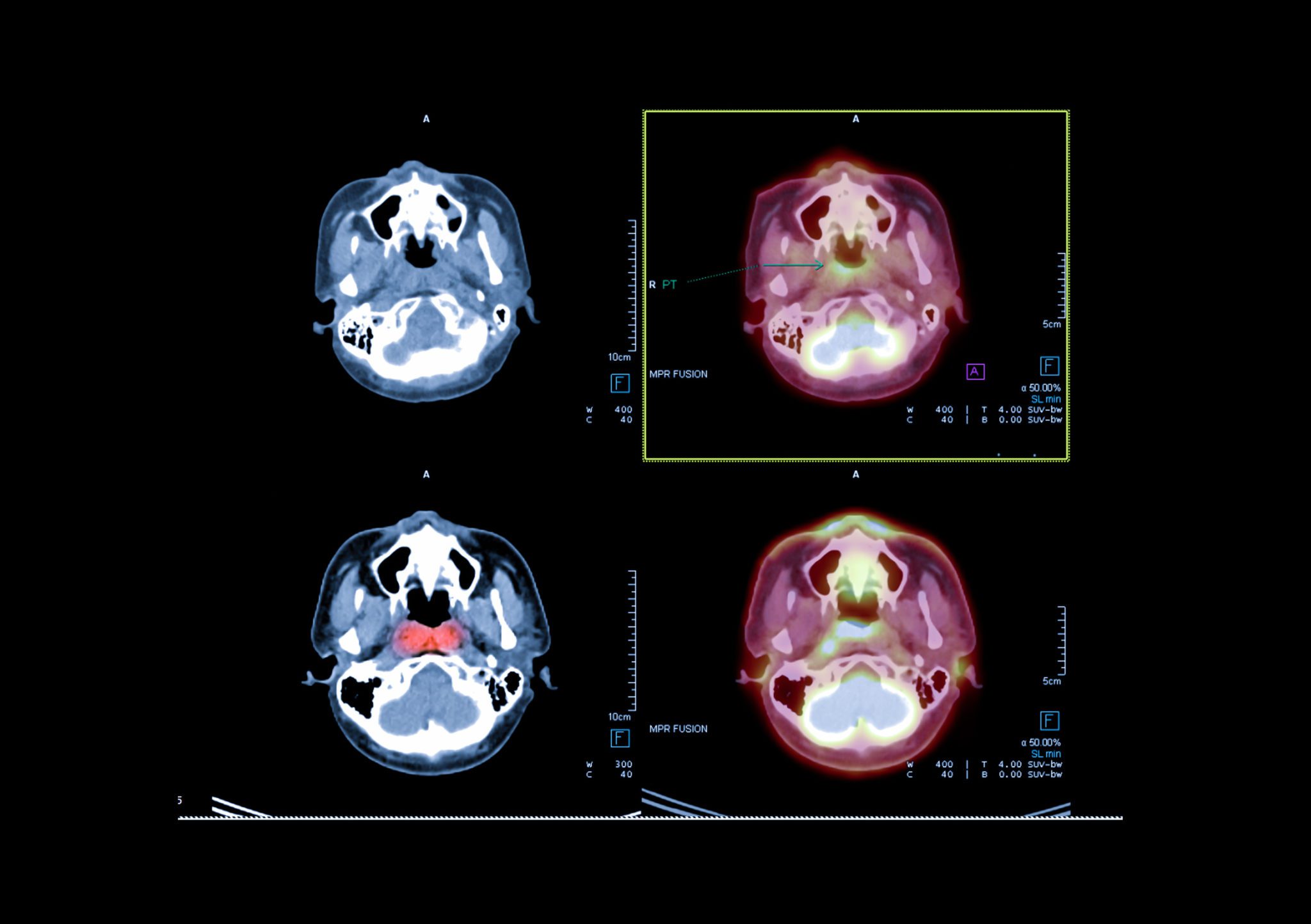 PET/CT • Touchstone Medical Imaging • Schedule Today