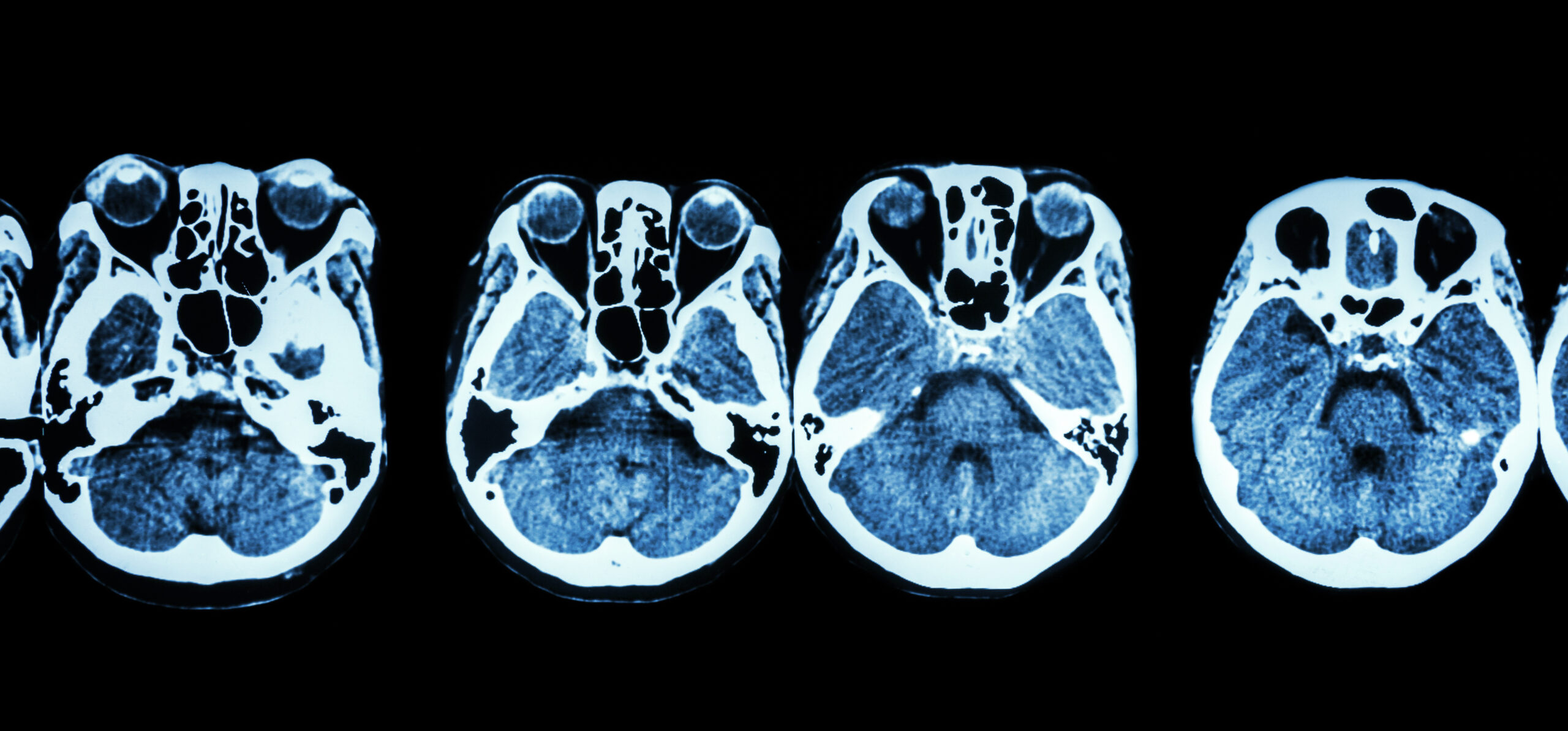How does a sinus CT scan help to diagnose breathing problems ...