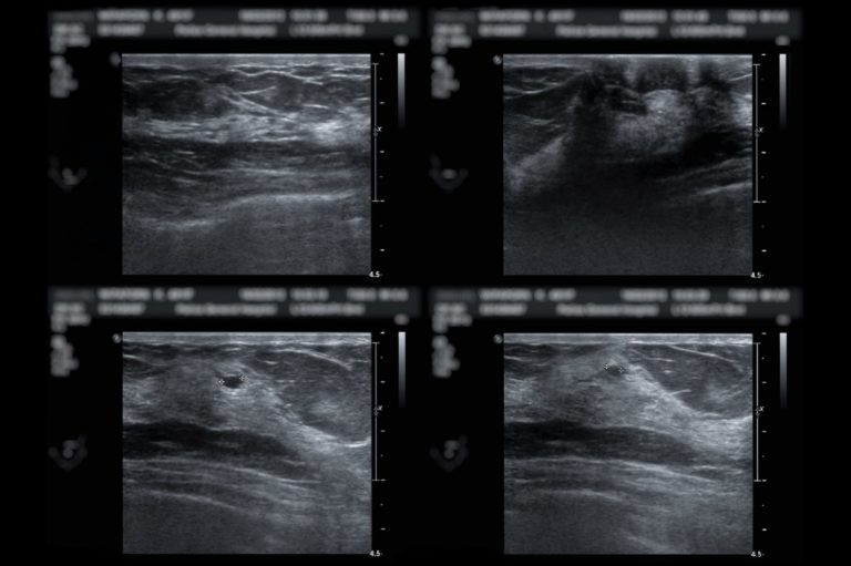 Automated Breast Ultrasound • Touchstone Medical Imaging