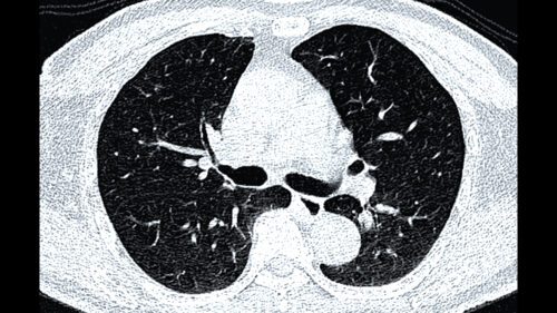 Low Dose Lung Screening CT • Touchstone Medical Imaging